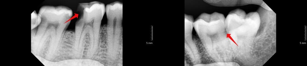 Cavities/Tooth decay : Causes, Stages, and Treatment