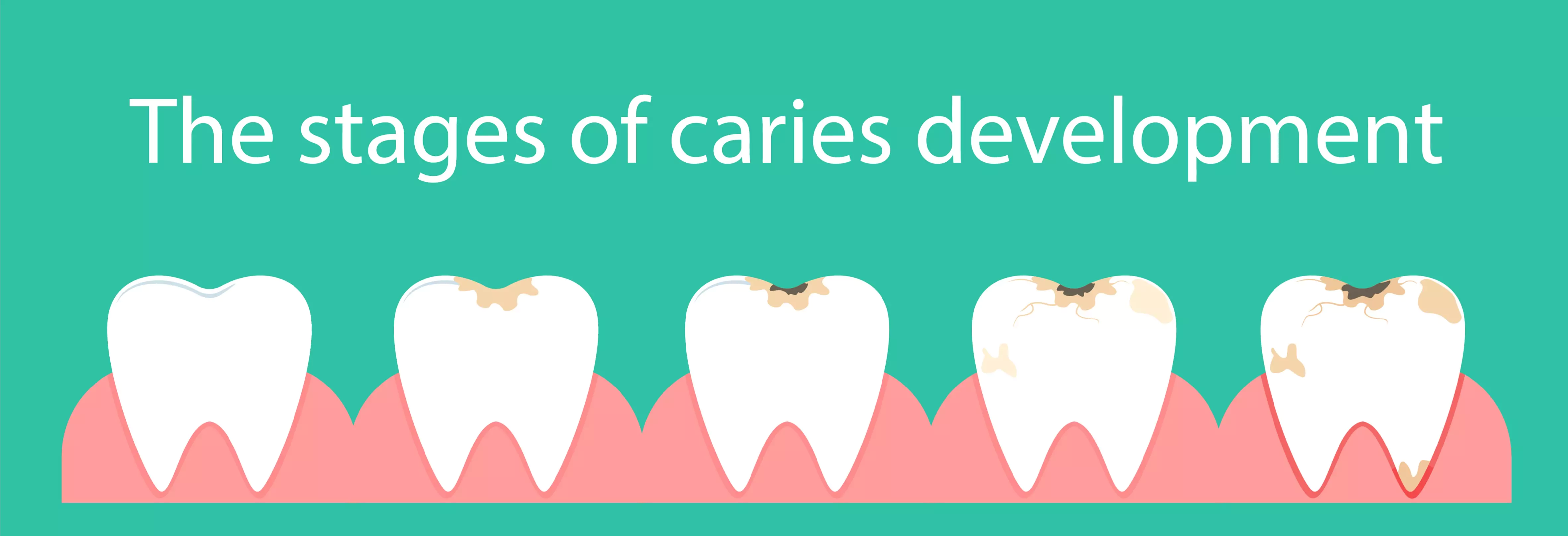 Stages Of Dental Caries 5 Stages Of Tooth Decay