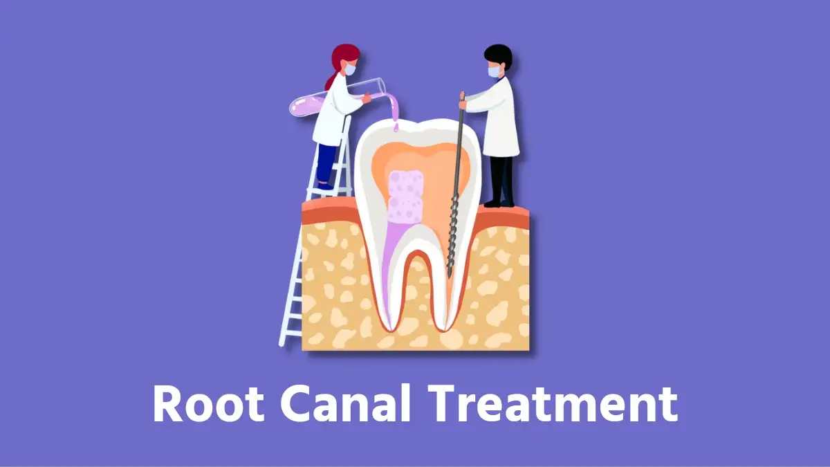 What is Root Canal Treatment (RCT) : Step by Step Procedure
